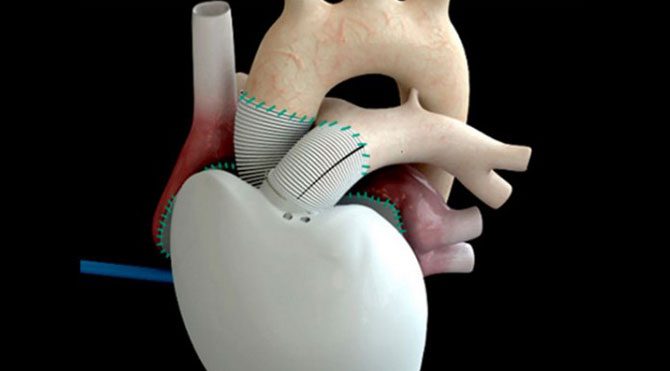 Tamamen yapay kalp üretildi! - Sözcü