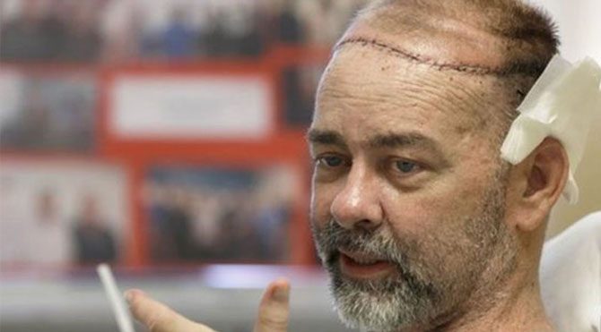 ABD'de kafatası nakli yapıldı! - Sözcü