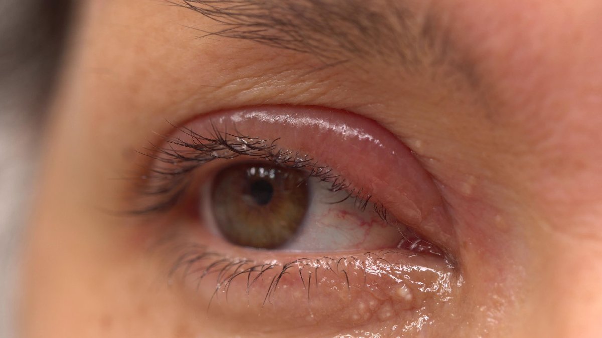 Arpacık nasıl geçer? Arpacık bulaşır mı?